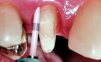 Komet USA | CeraTip Kit | 4651 | Gingival Tissue Trimmer Bur